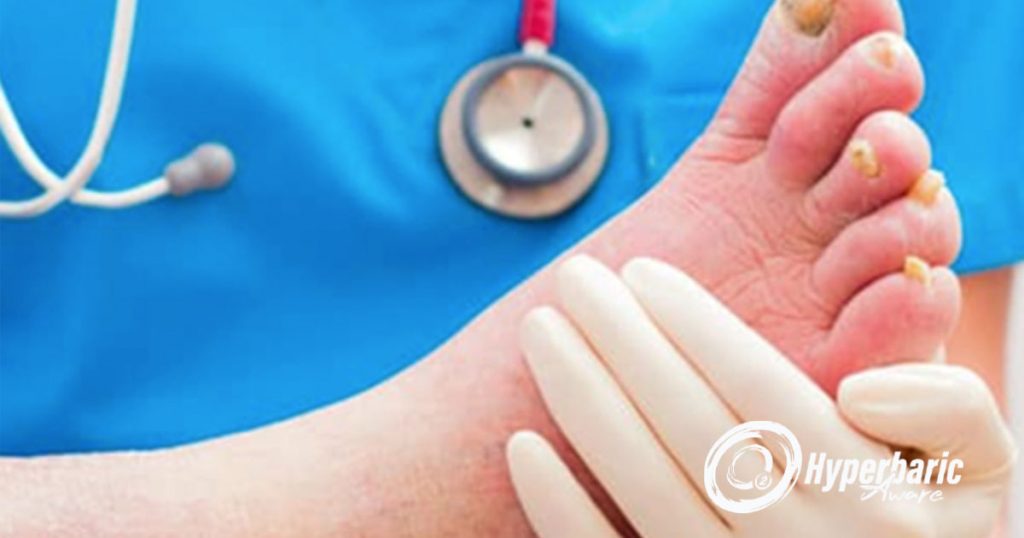 Hyperbaric Aware - Diabetic Foot Ulcers | Diabetic Foot Wounds