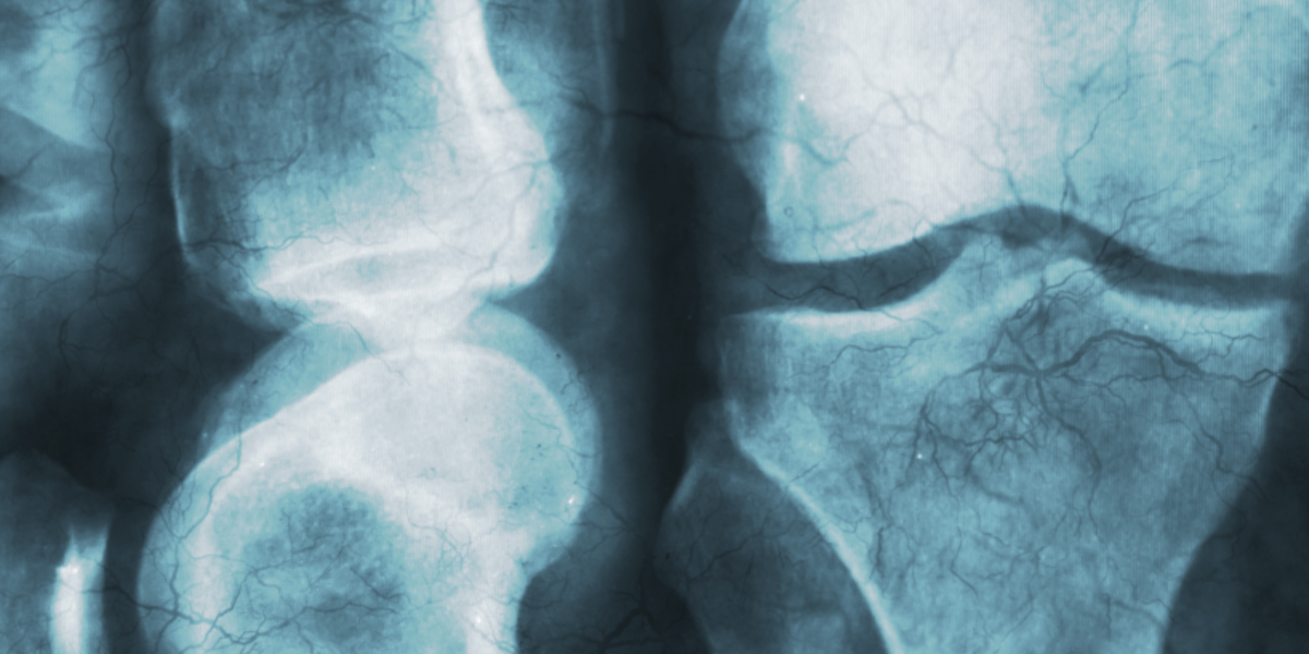 Treating Chronic Refractory Osteomyelitis with HBOT