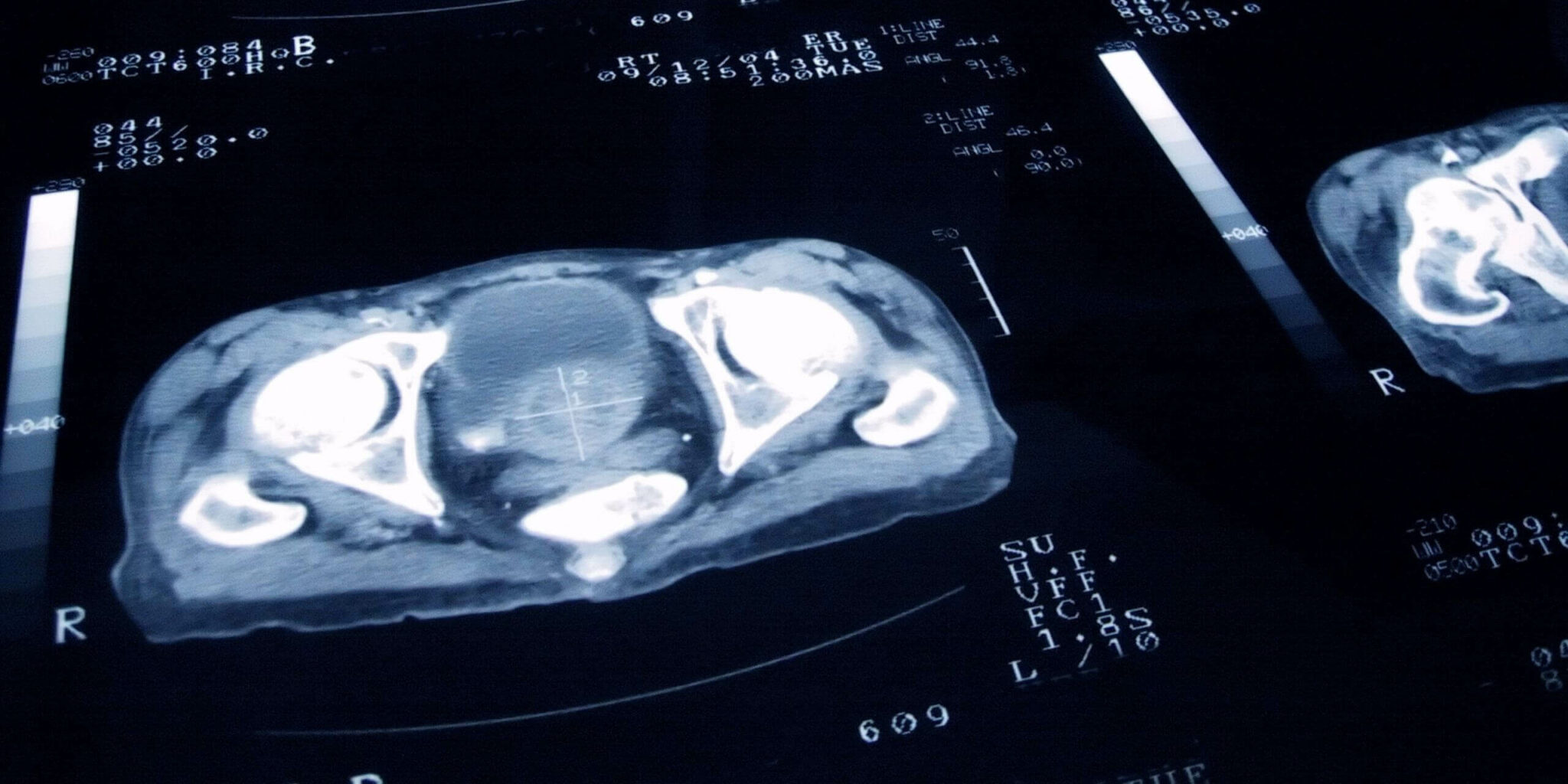 Navigating Radiation Cystitis in Prostate Cancer Patients